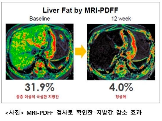 美FDA, 한미약품 지방간염 치료제 '패스트트랙' 지정